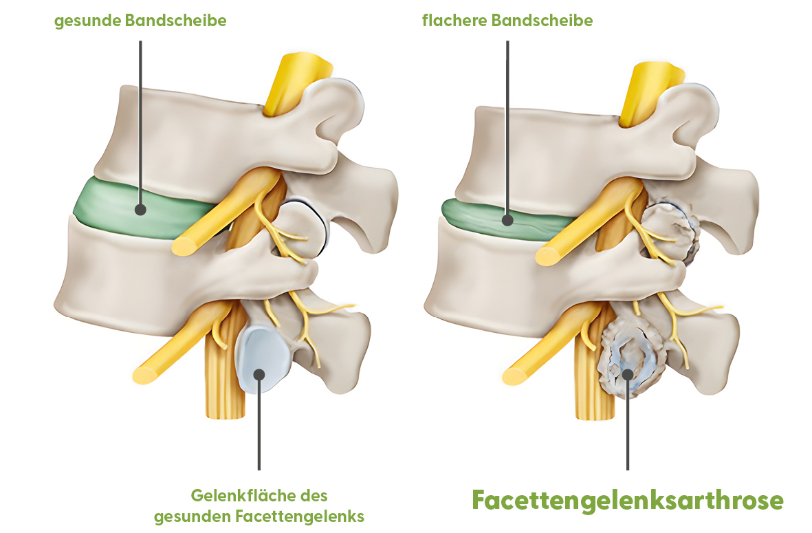 Infiltrationstherapie an der Wirbelsäule – ZOSU – Orthopädie ...
